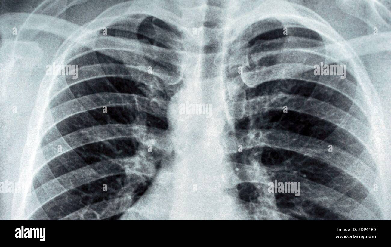 Pneumonia lungs xray hi-res stock photography and images - Alamy