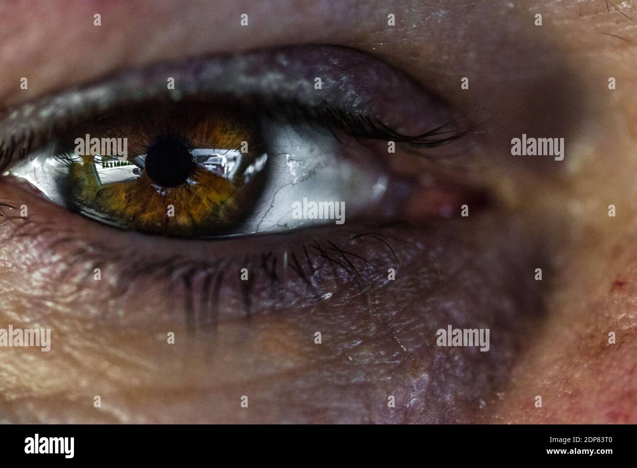 Bruised eye man hi-res stock photography and images - Alamy