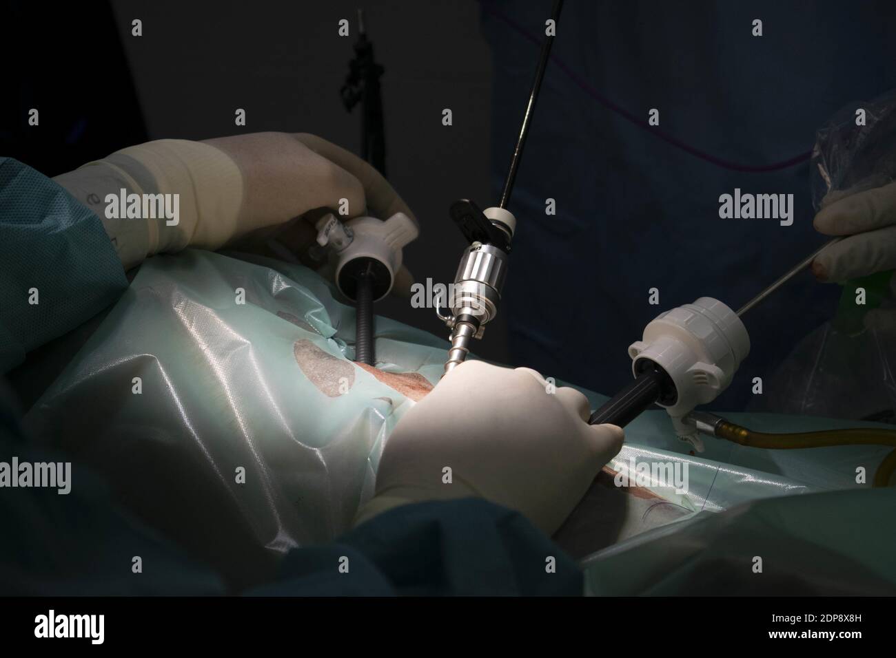A closeup shot of tree hands with surgical instruments during a ...