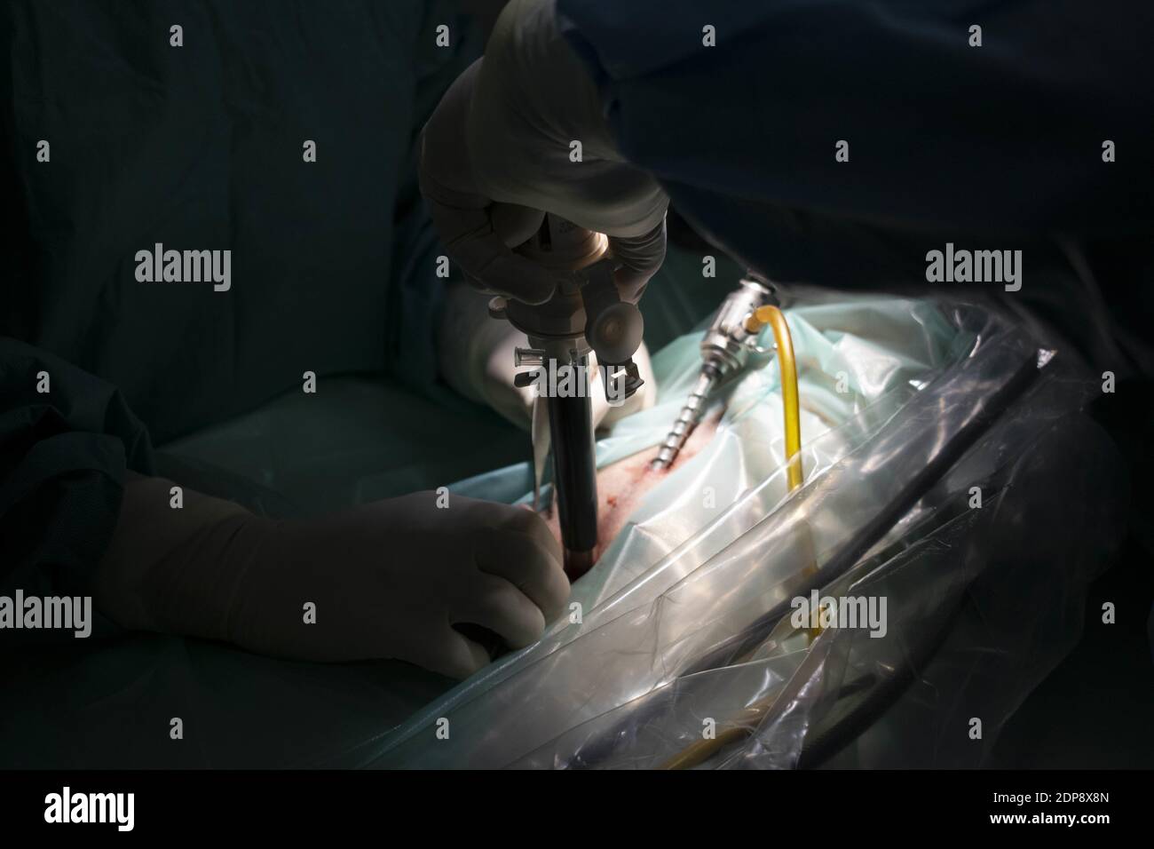 A closeup shot of hands with surgical instruments during a surgical ...