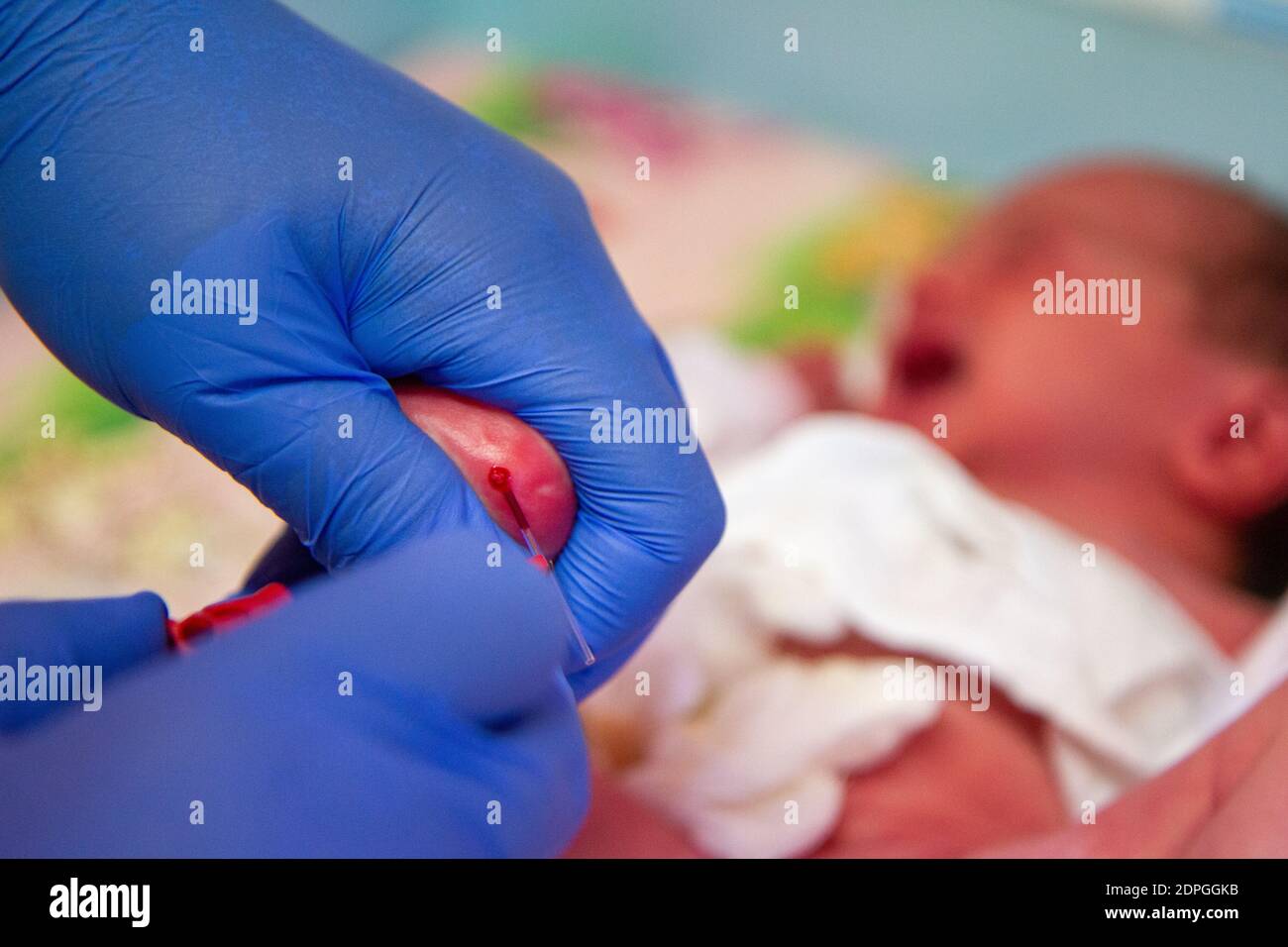 Newborn blood spot or heel prick test (the Guthrie test). A ...