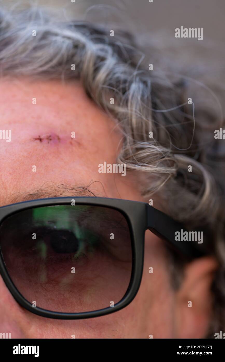 Head Wound Stitches High Resolution Stock Photography and Images - Alamy
