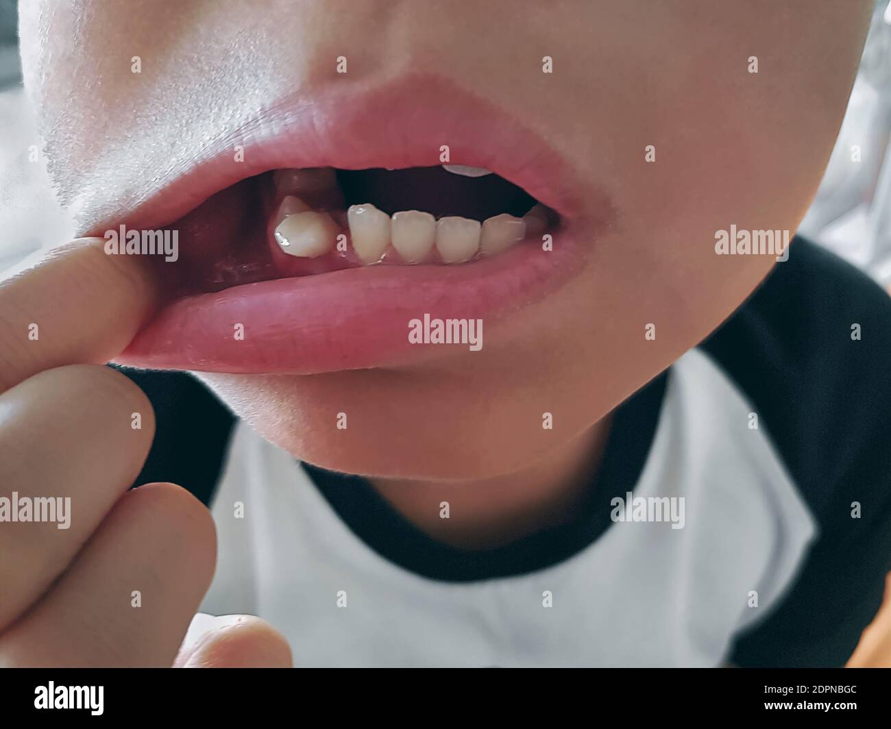 Boy broken teeth hi-res stock photography and images - Alamy
