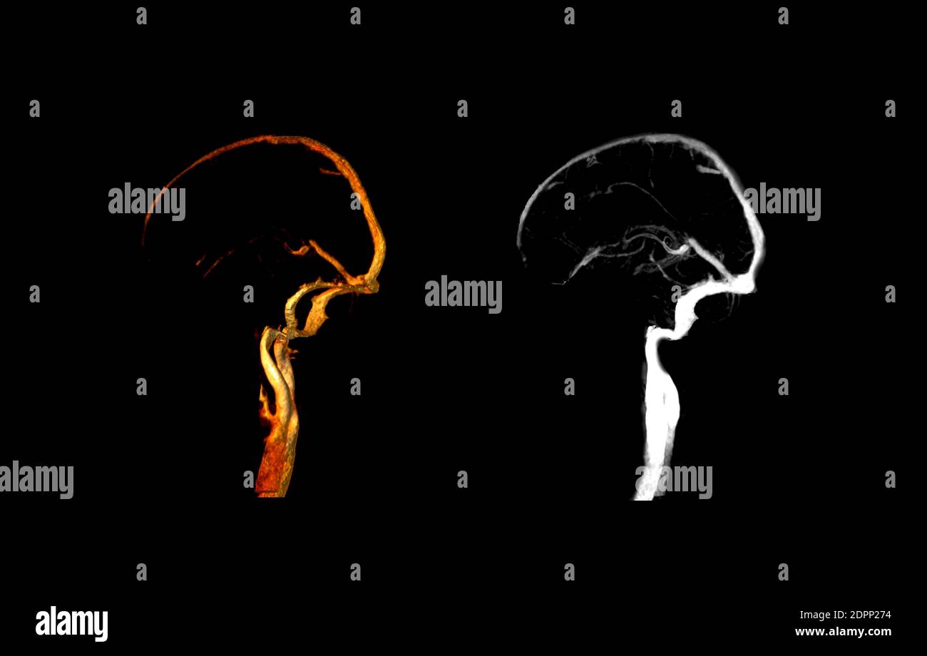 Ctv brain hi-res stock photography and images - Alamy