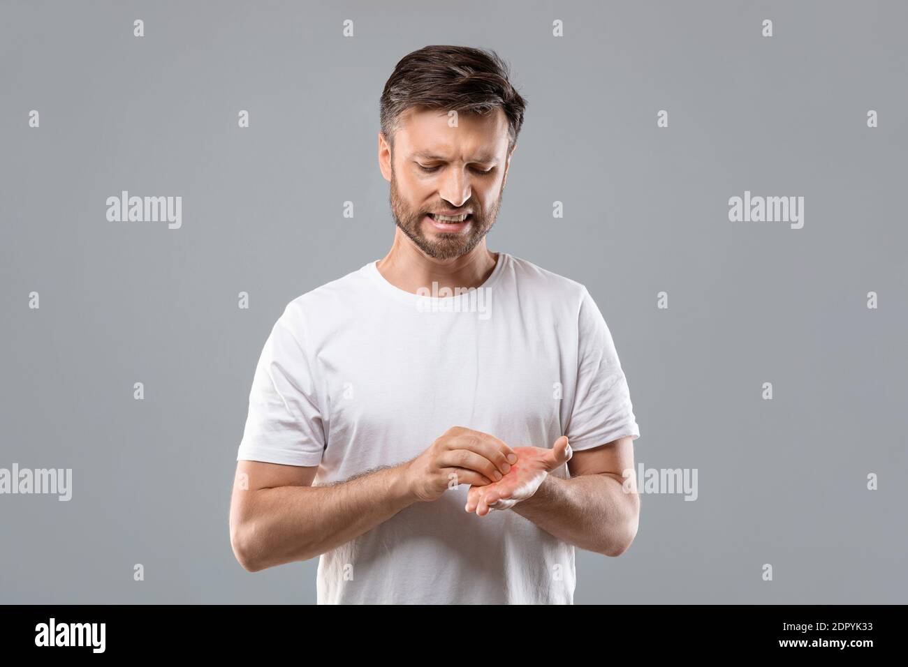 Itchy skin rash hi-res stock photography and images - Alamy