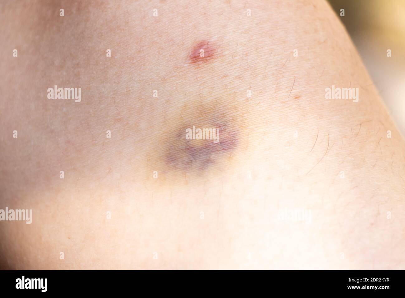 Closed up background of violet lesion on asian woman skin Stock Photo ...