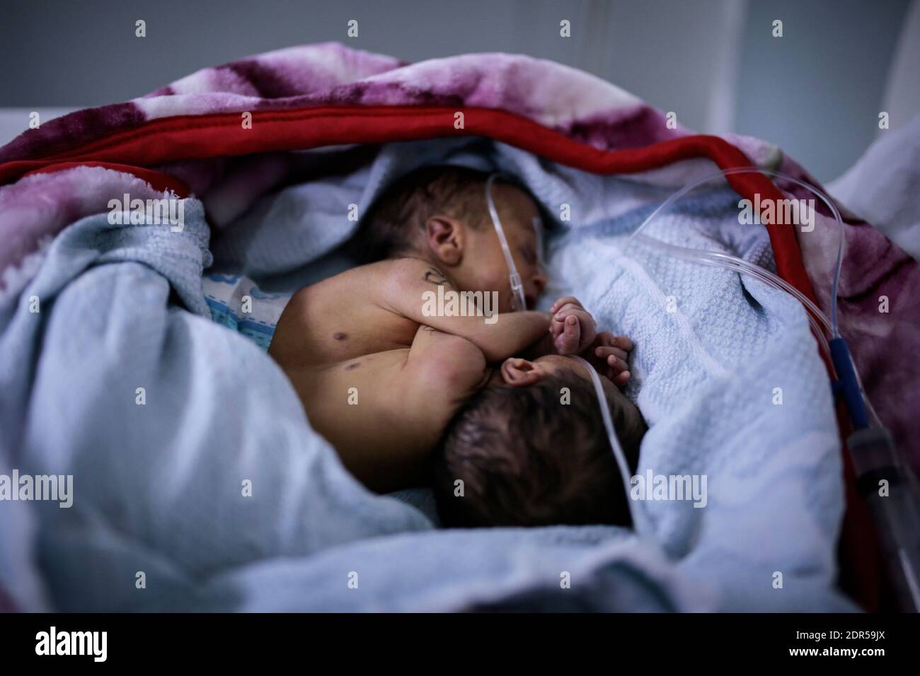 Conjoined twin human hi-res stock photography and images - Alamy