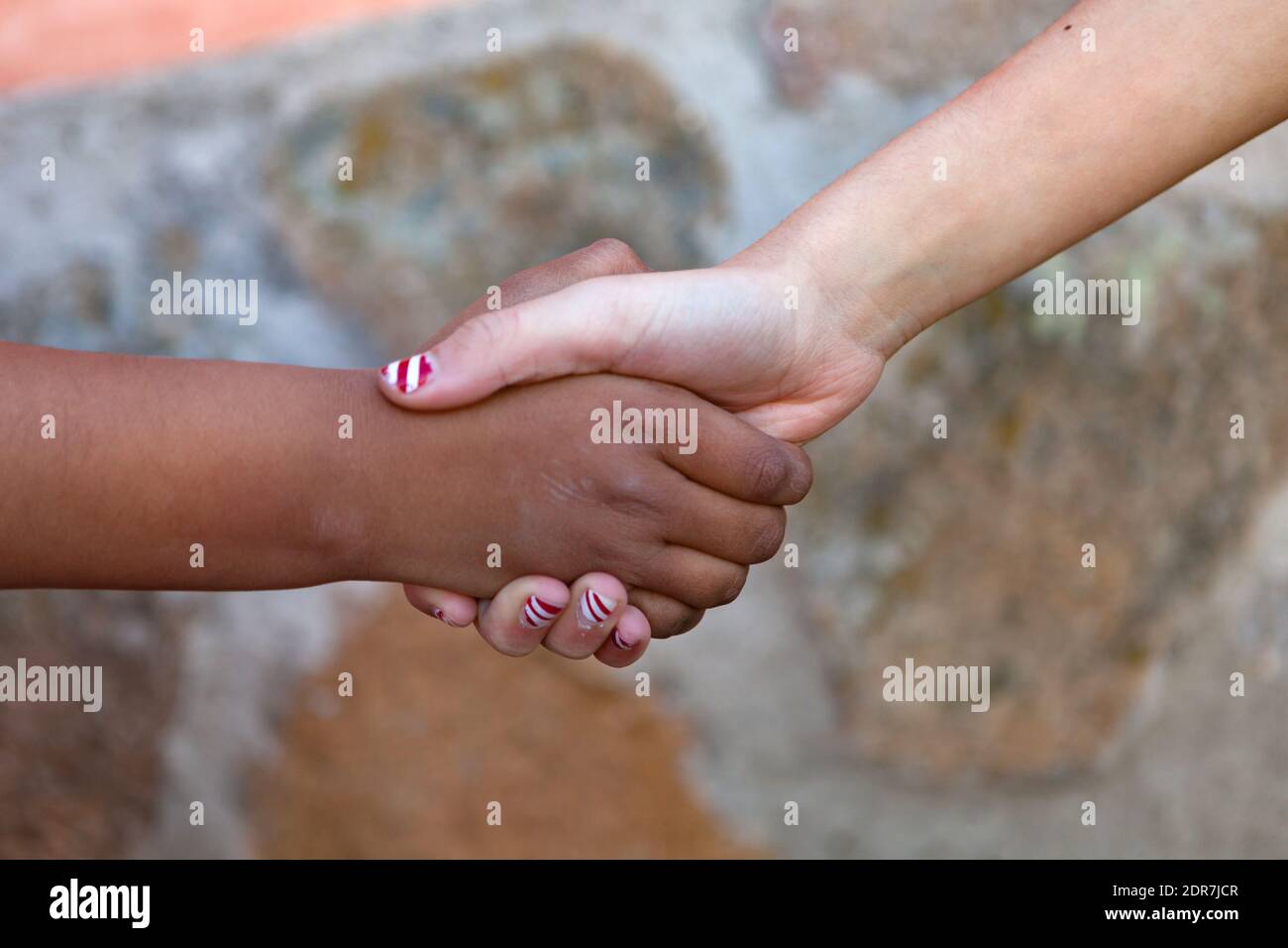 Limb difference hi-res stock photography and images - Alamy