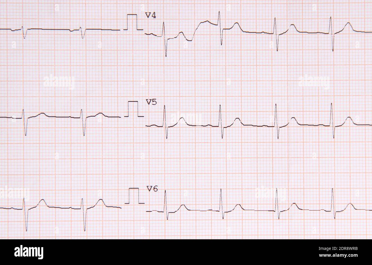Ecg Chart High Resolution Stock Photography and Images - Alamy