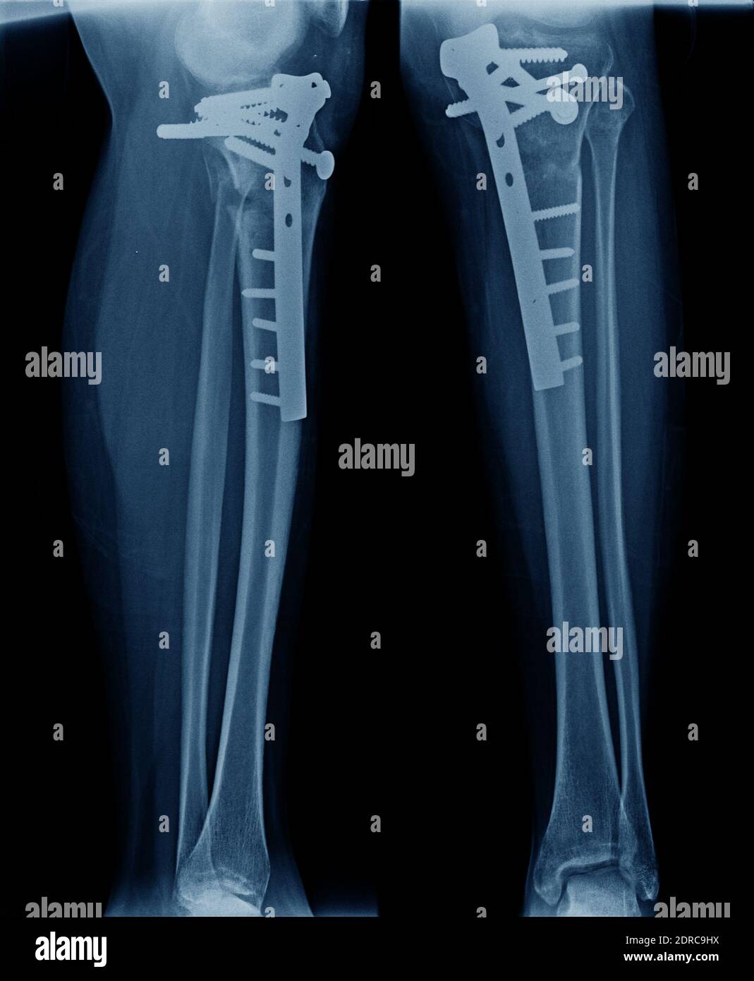 Screw anatomy hi-res stock photography and images - Alamy
