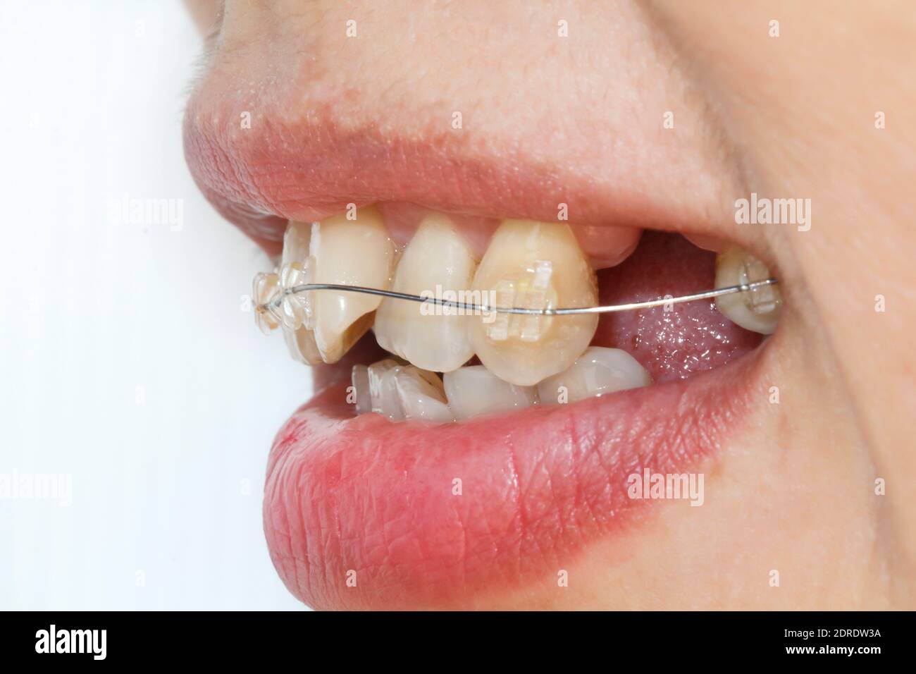 Close up mouth crooked teeth hi-res stock photography and images - Alamy