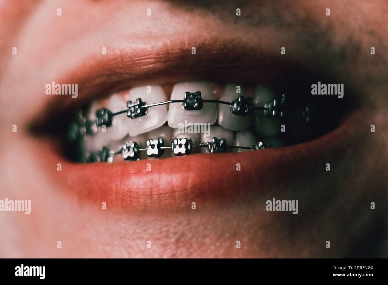 Man Braces Teeth High Resolution Stock Photography and Images - Alamy
