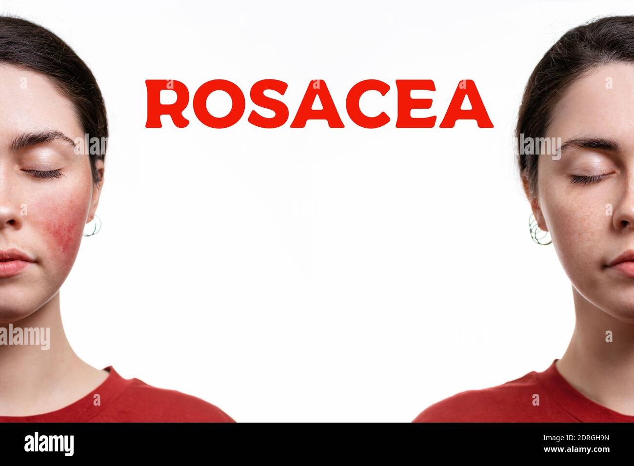 Two parts of a portrait of a young Caucasian woman with rosacea on her ...