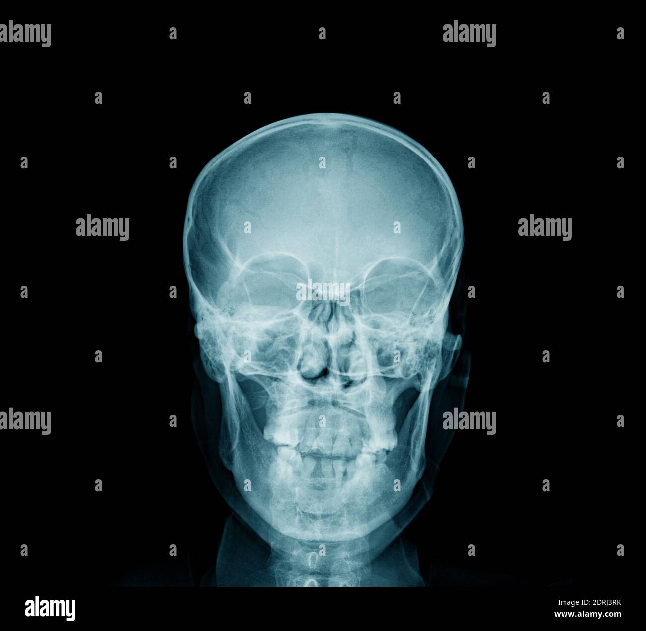 Human Skull X Ray Image High Resolution Stock Photography and Images ...