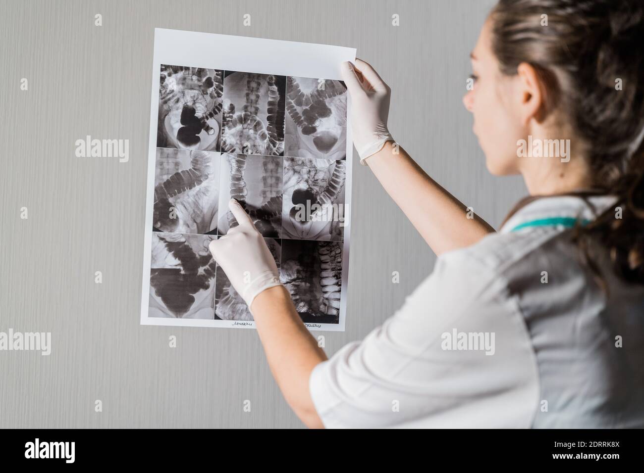 Woman doctor checking the intestine xray of dolichocolon person Stock ...