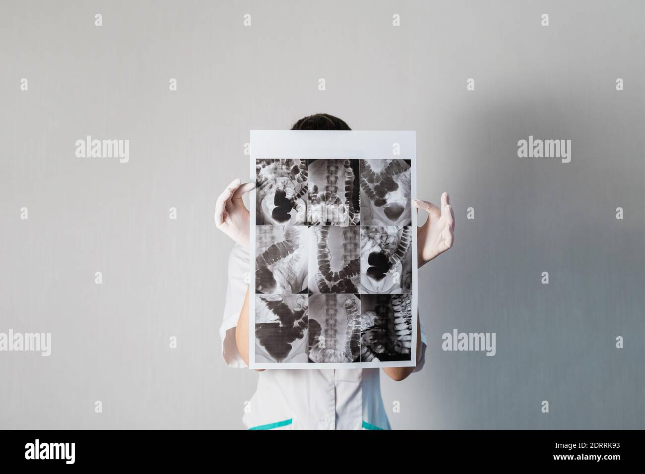 Woman doctor checking the intestine xray of dolichocolon person Stock ...