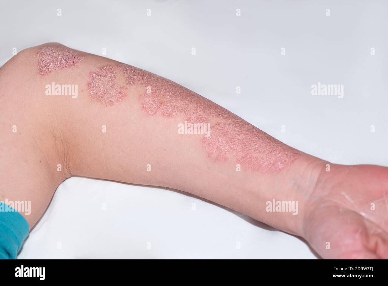 Psoriasis hand hi-res stock photography and images - Alamy