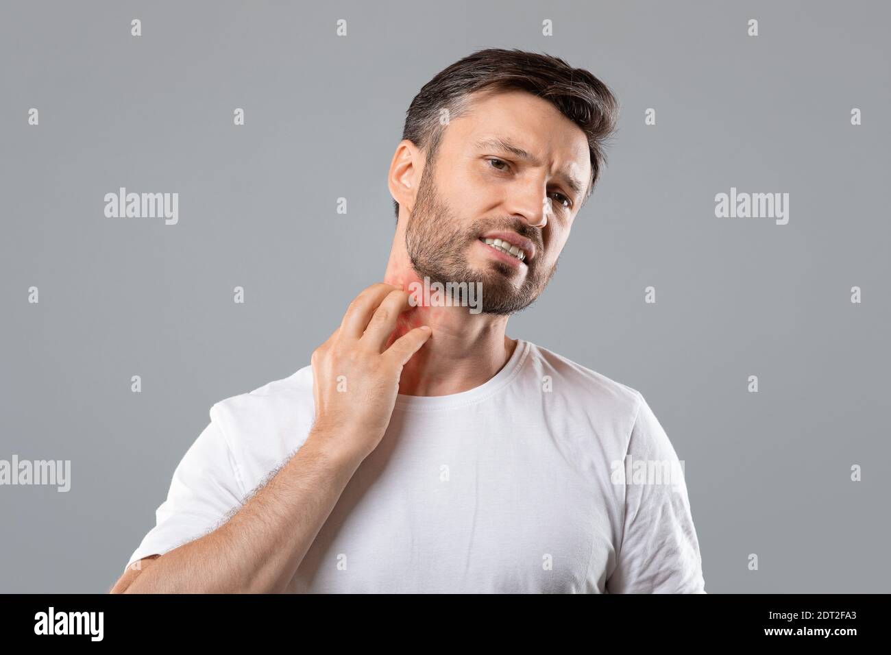 Skin rash urticaria allergic skin hi-res stock photography and images ...