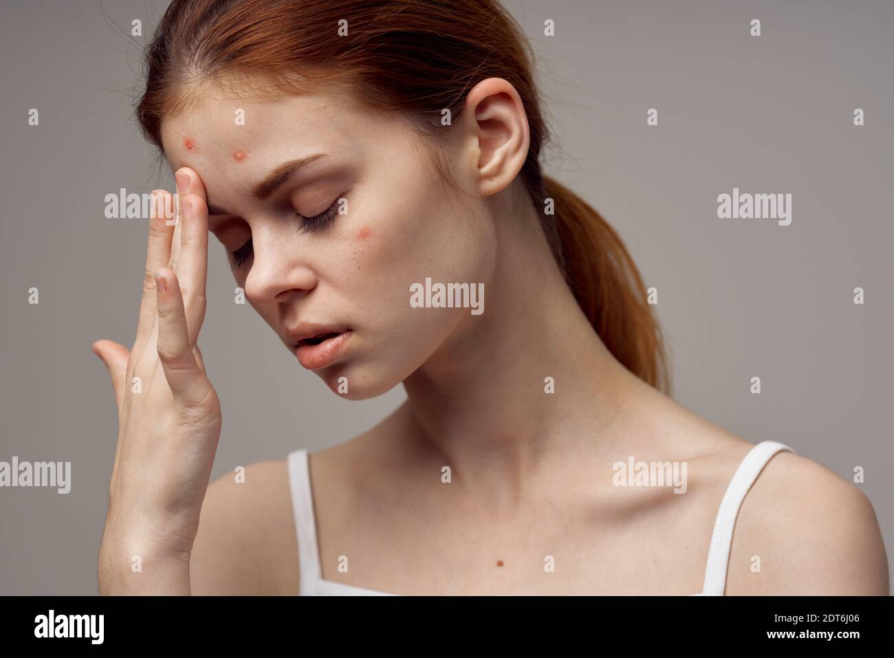 woman clean skin acne acne health problems dermatology Stock Photo - Alamy