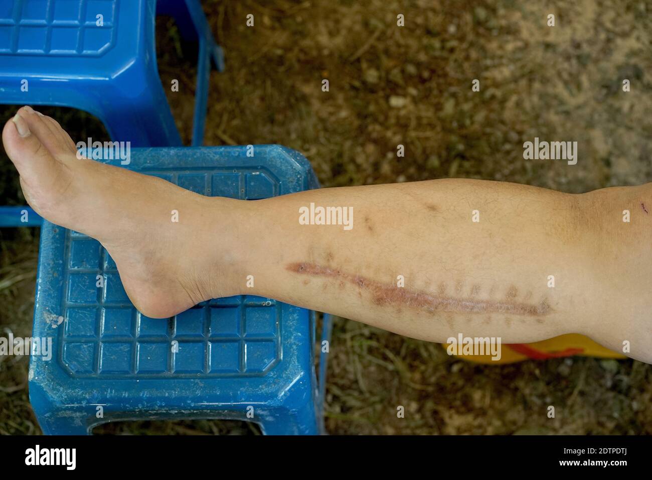 Foot Stitches High Resolution Stock Photography and Images - Alamy