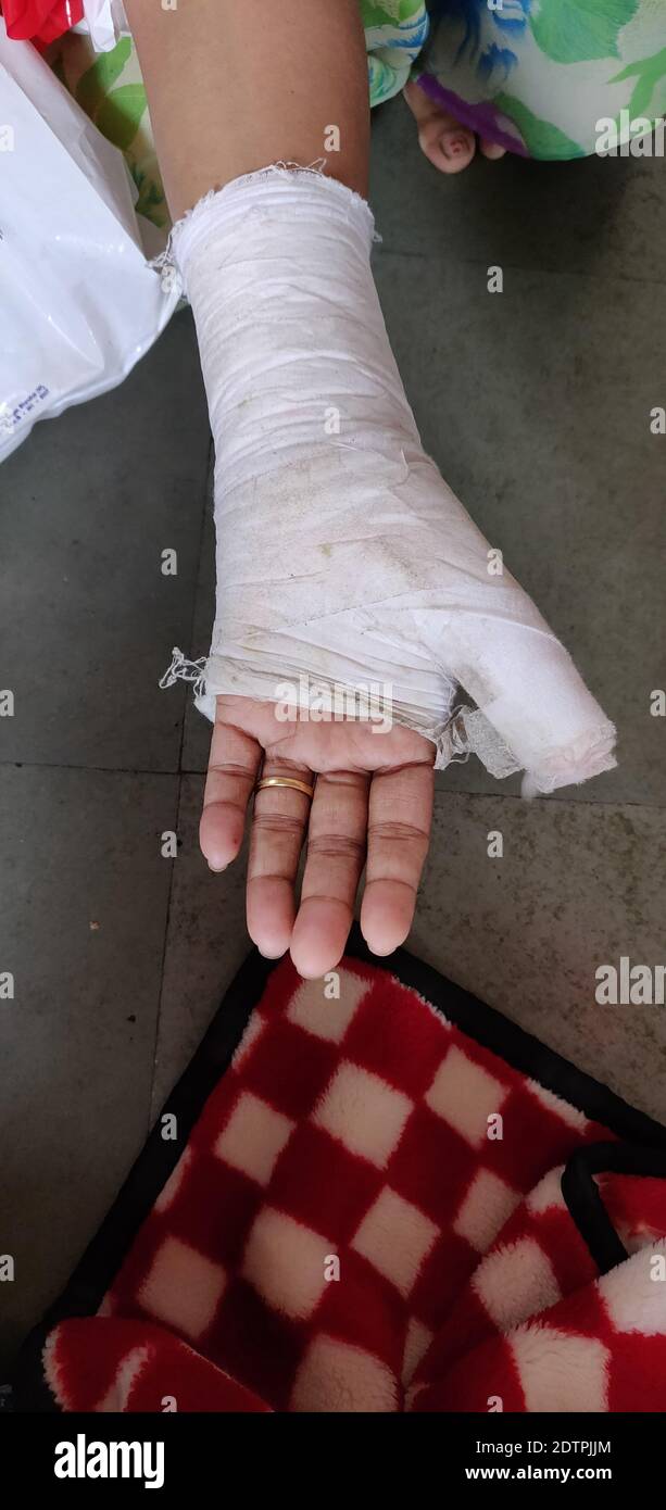 Fracture hand High Resolution Stock Photography and Images - Alamy
