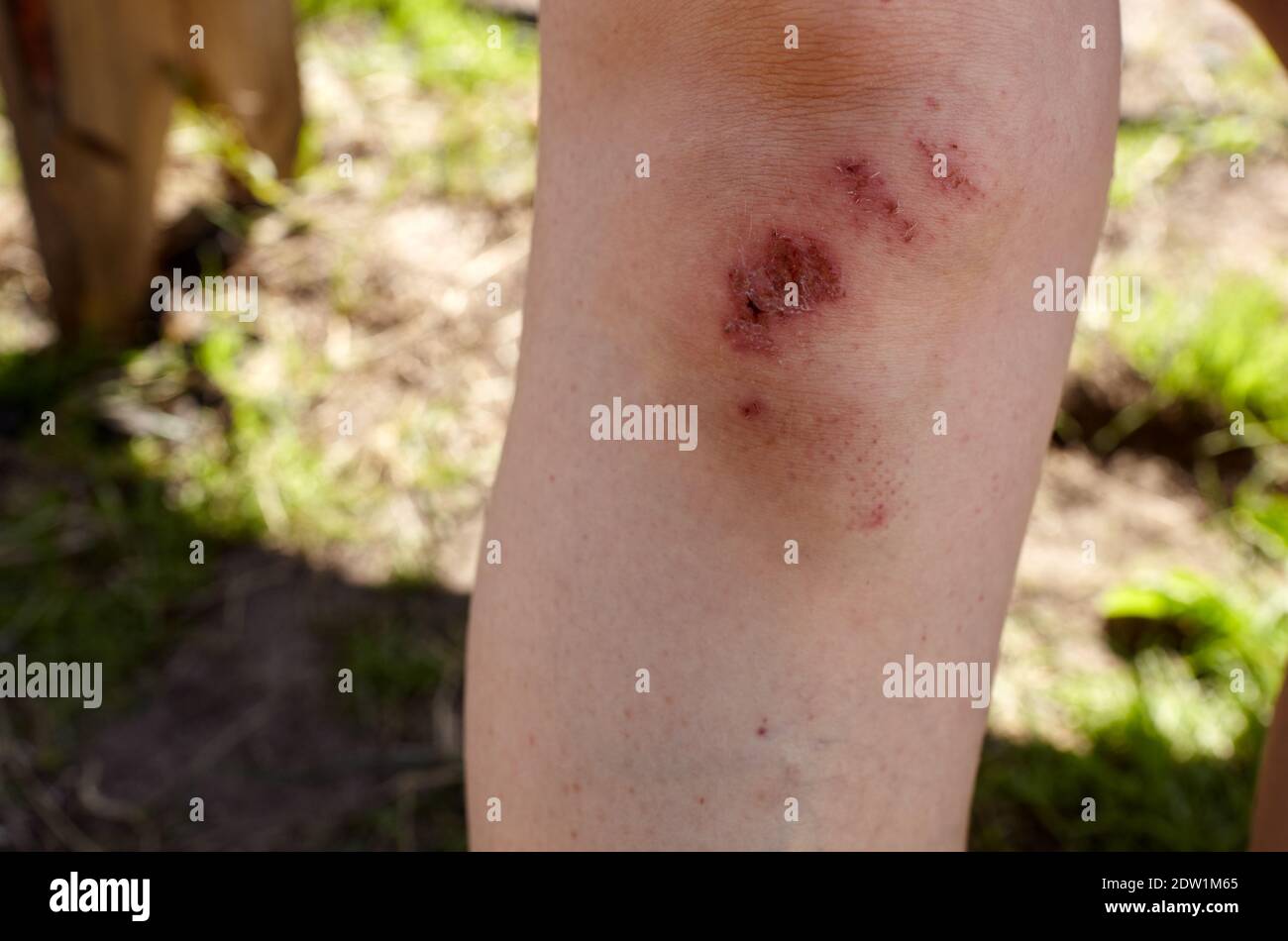 Runner contusion hi-res stock photography and images - Alamy