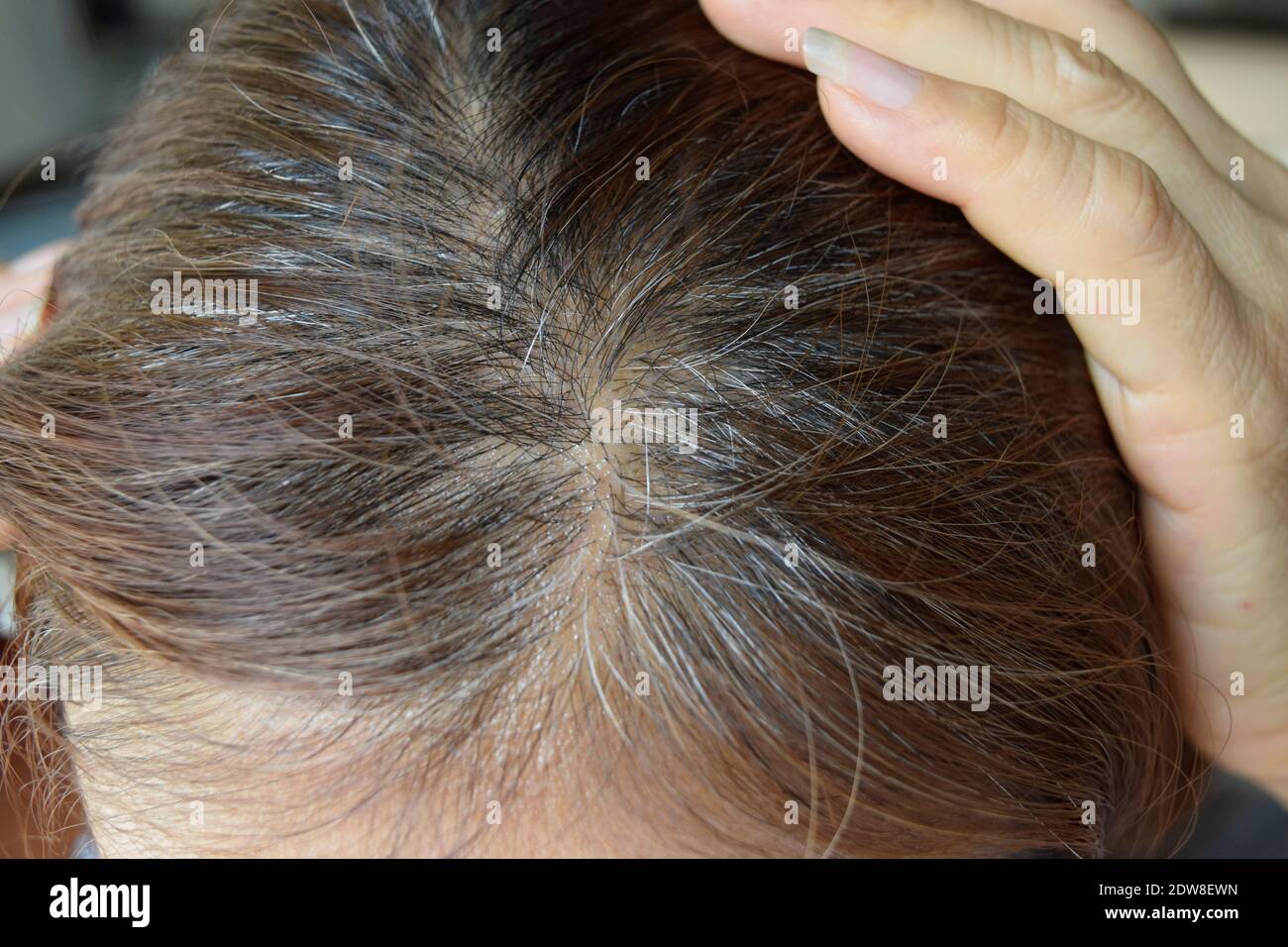 Human scalp hi-res stock photography and images - Alamy