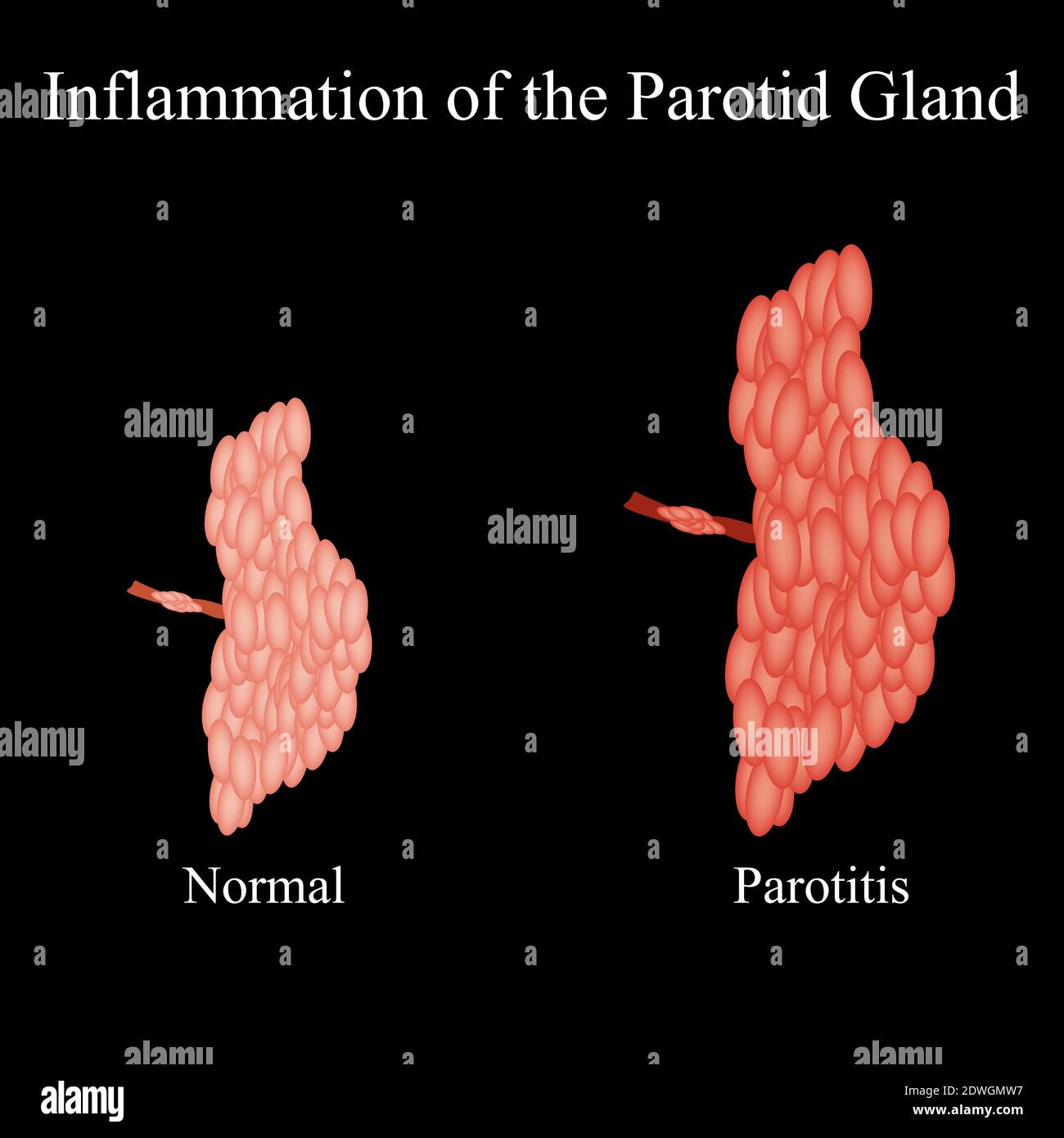 Inflammation of the parotid gland.The structure of the parotid salivary ...