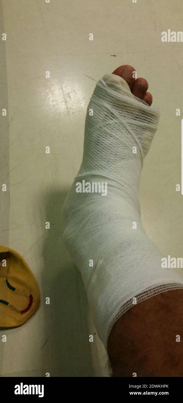 Fractured legs hi-res stock photography and images - Alamy