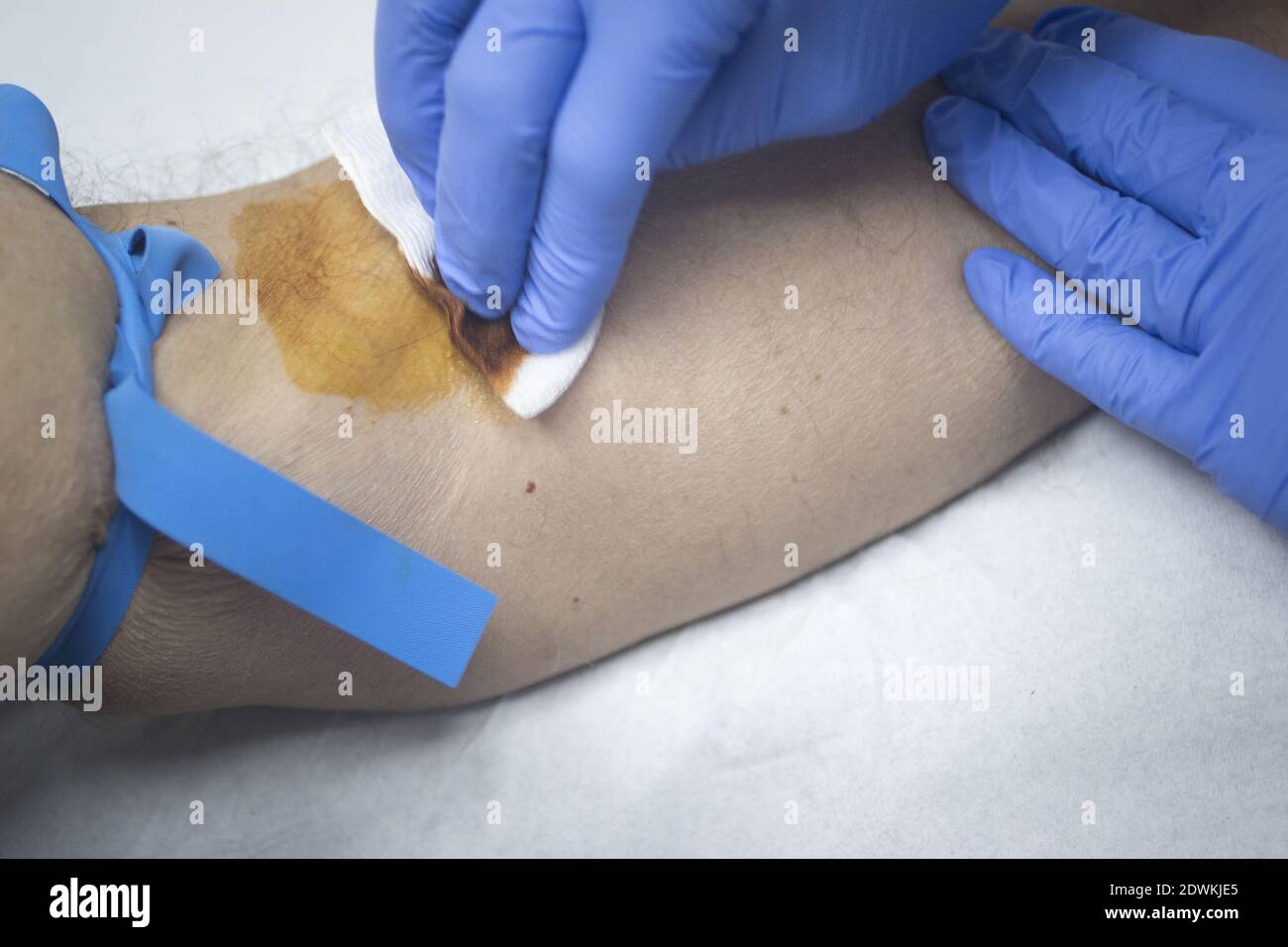 Wound arm cleaning hi-res stock photography and images - Alamy