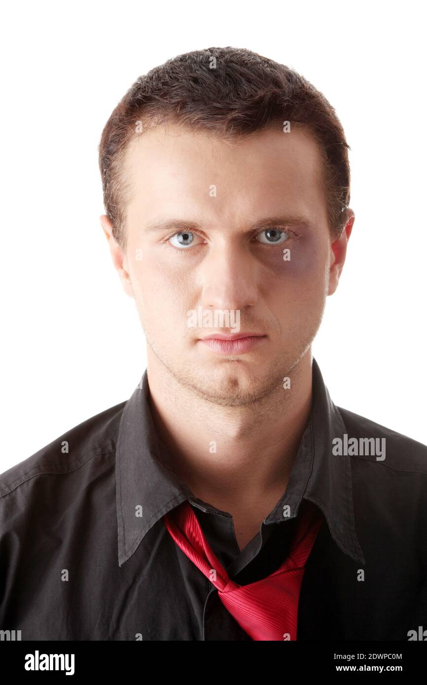 Bruise Around Eye High Resolution Stock Photography and Images - Alamy