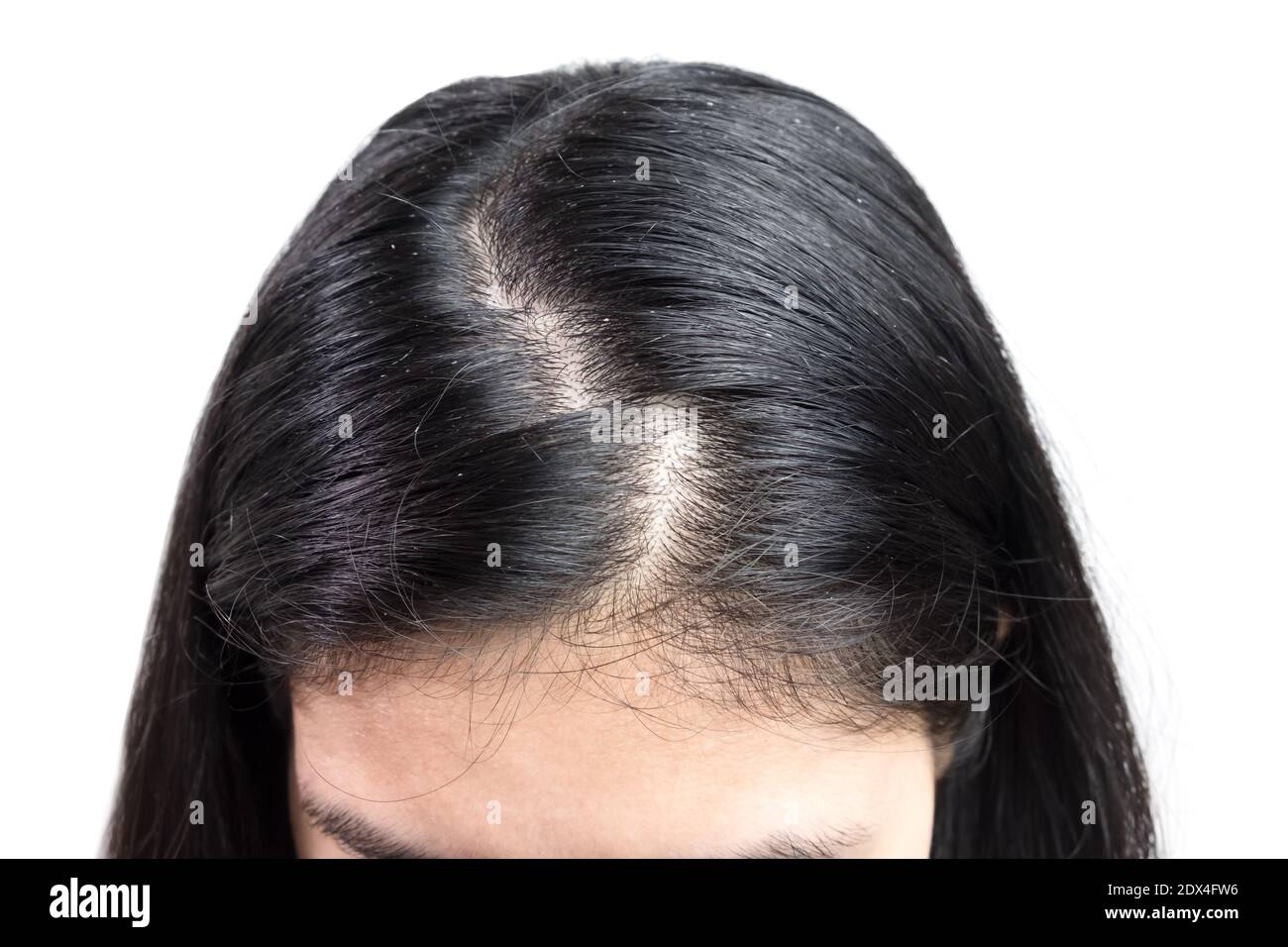 Hair dandruff hi-res stock photography and images - Alamy