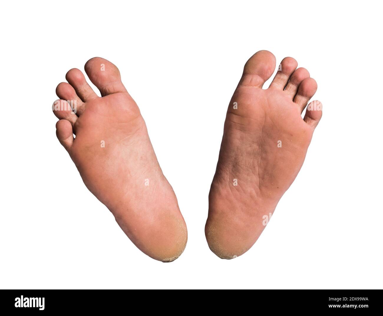 Cracked skin leg Cut Out Stock Images & Pictures - Alamy