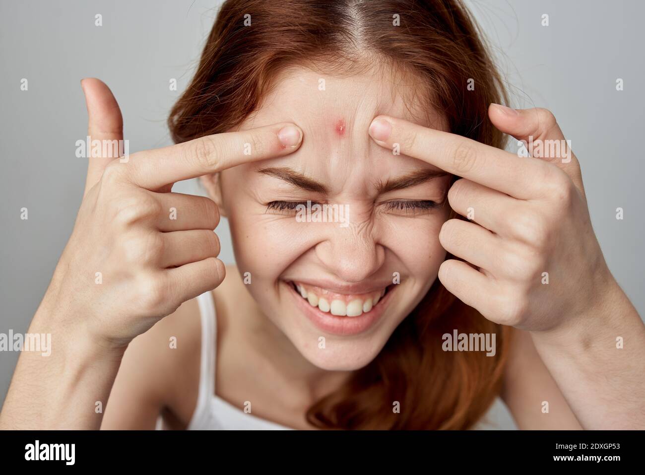 woman squeezes pimple on her forehead skin problems cosmetology Stock ...