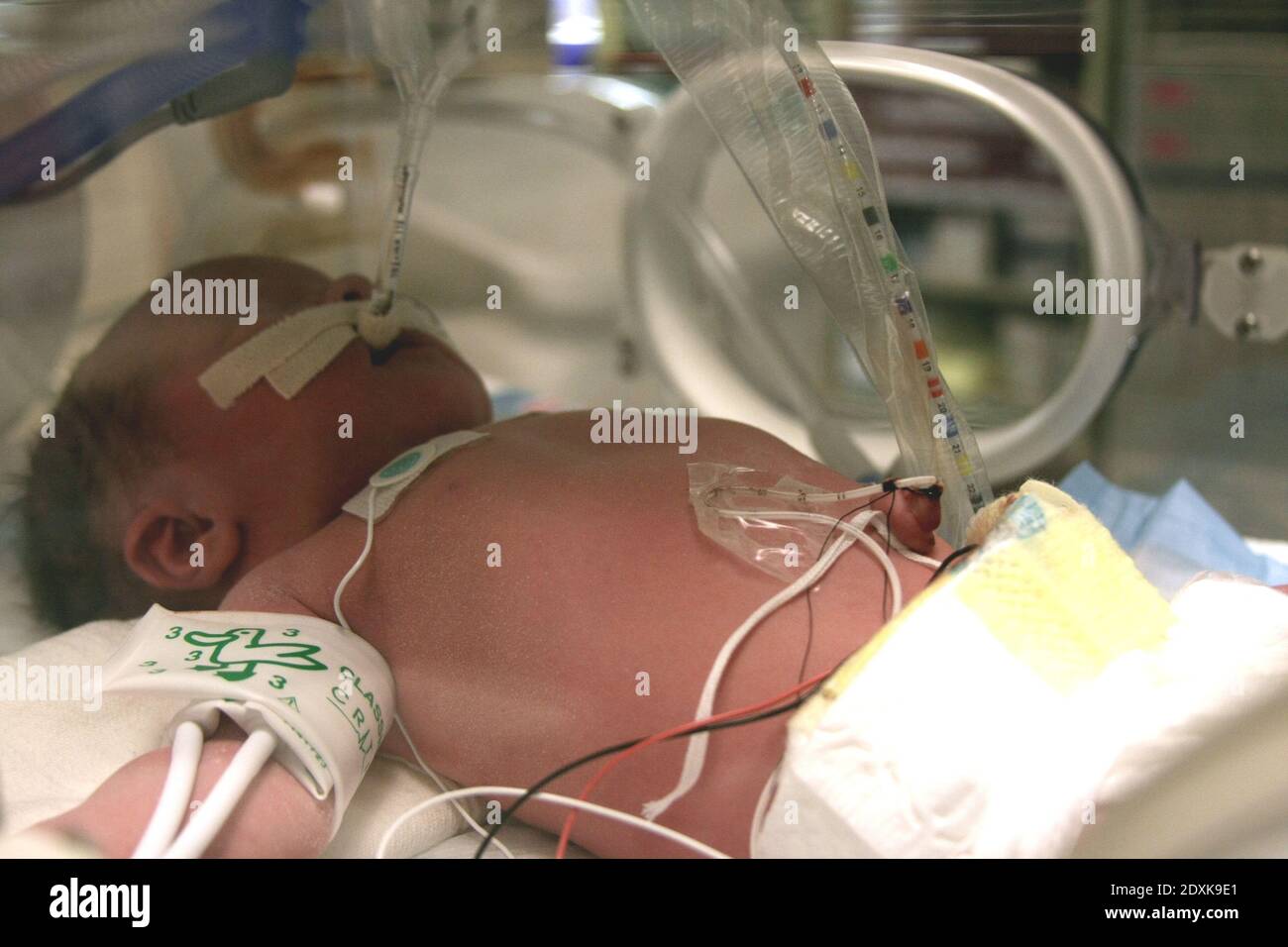 Premature baby in incubator hi-res stock photography and images - Alamy