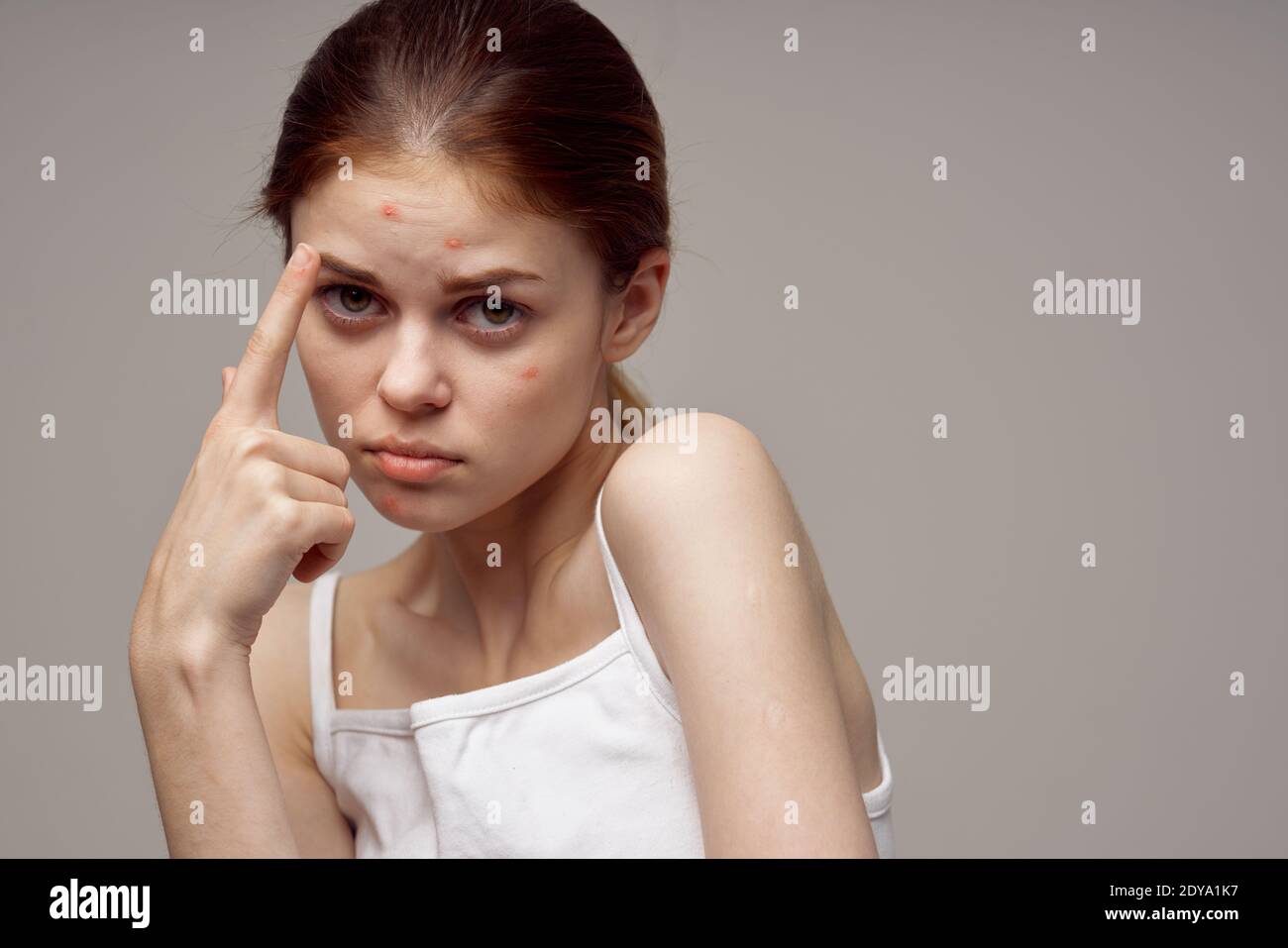 beautiful woman gesturing with her hands near face acne skin problems ...