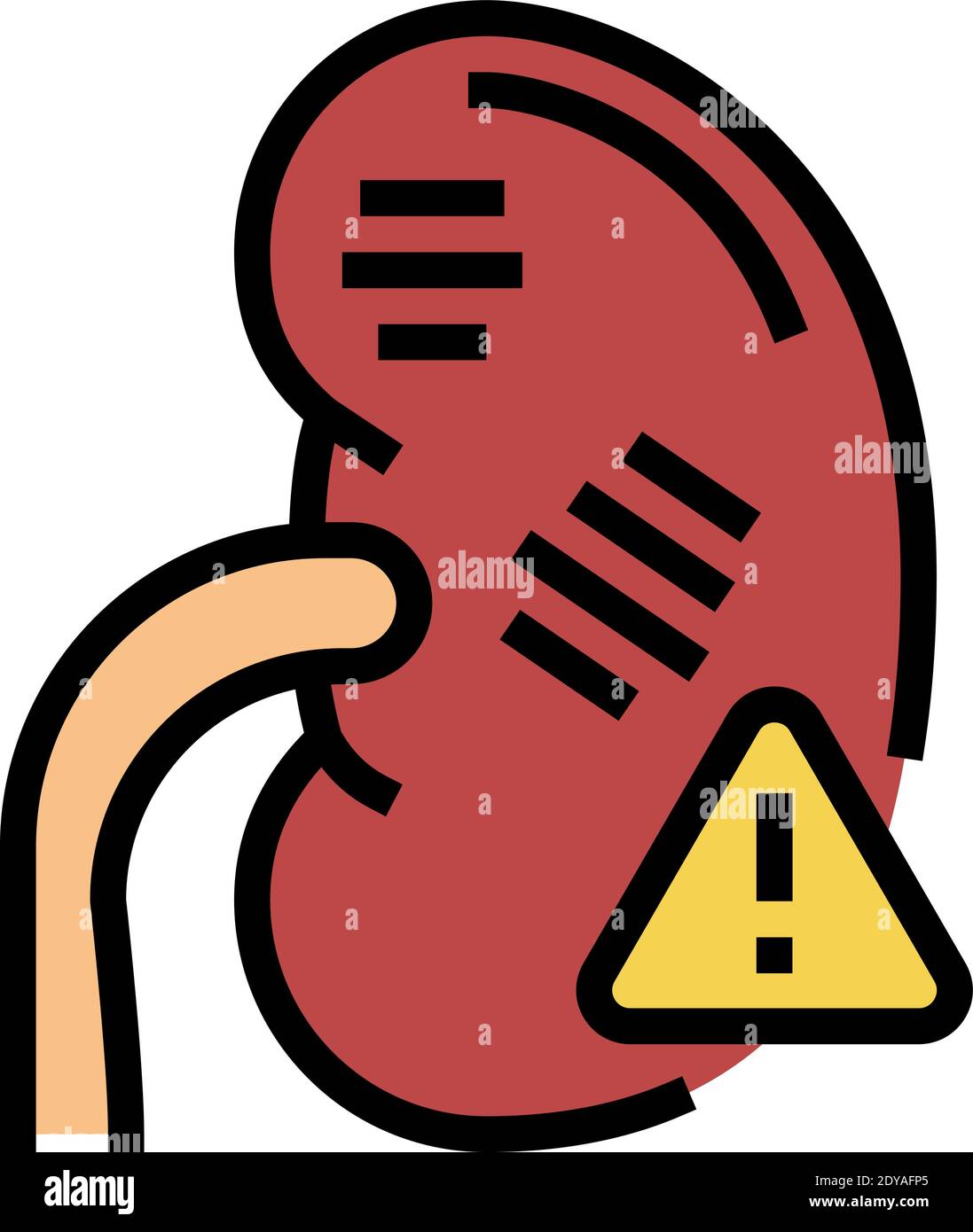 Nephritis Stock Vector Images - Alamy