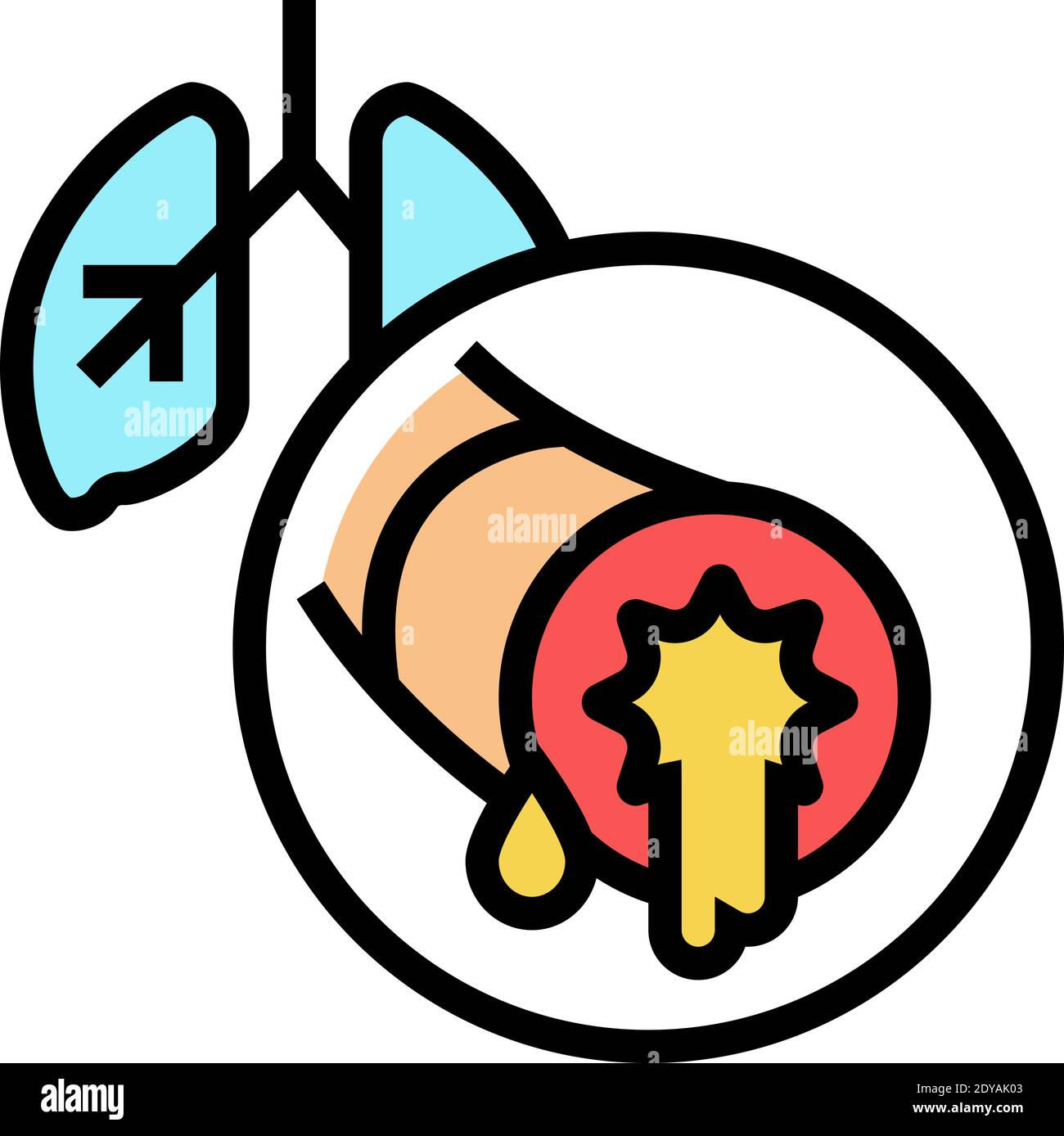 Bronchiectasis High Resolution Stock Photography and Images - Alamy