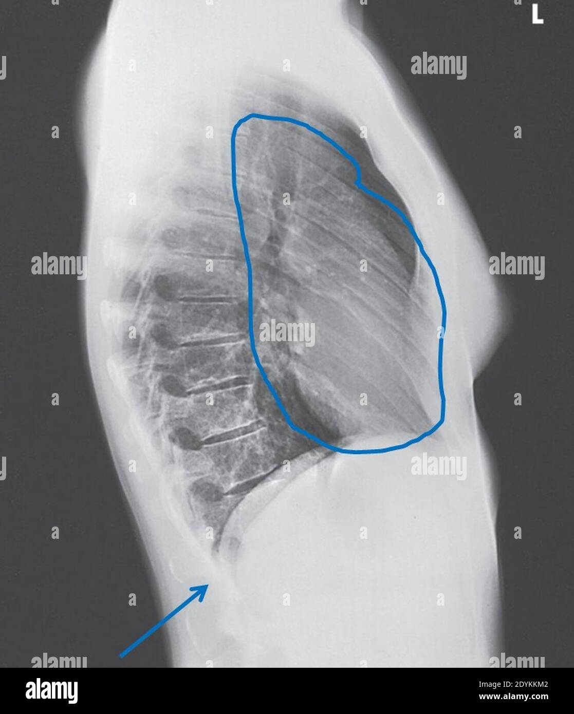 Lateral Chest X-Ray Stock Photo - Alamy
