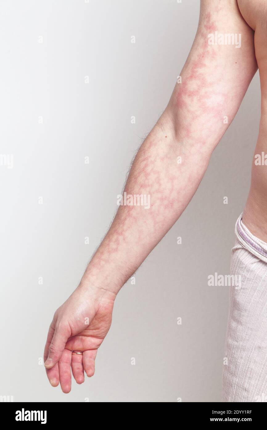 Male arm with red skin capillary network Stock Photo - Alamy