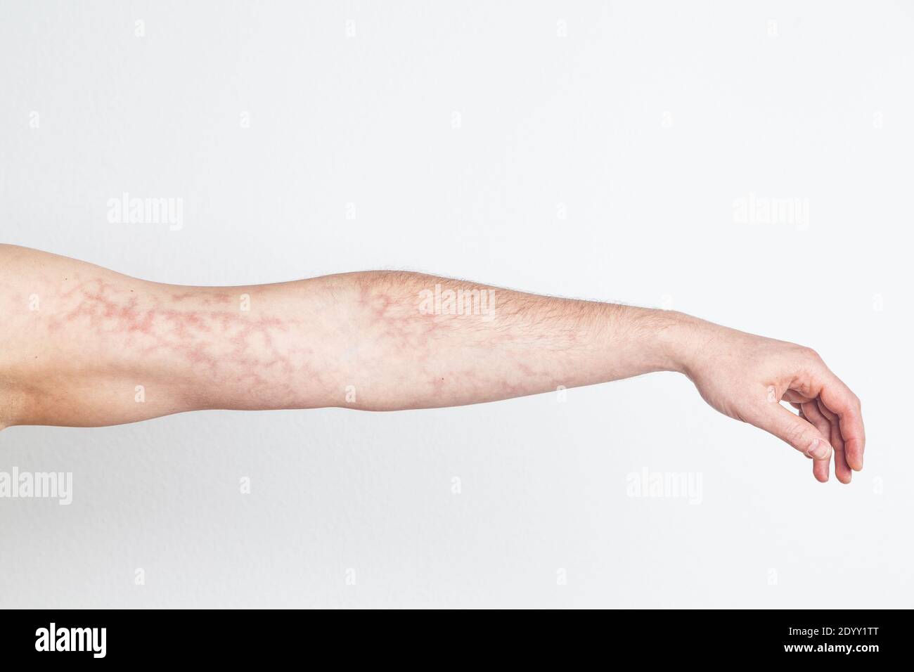 Male upright left arm with red skin capillary network Stock Photo - Alamy