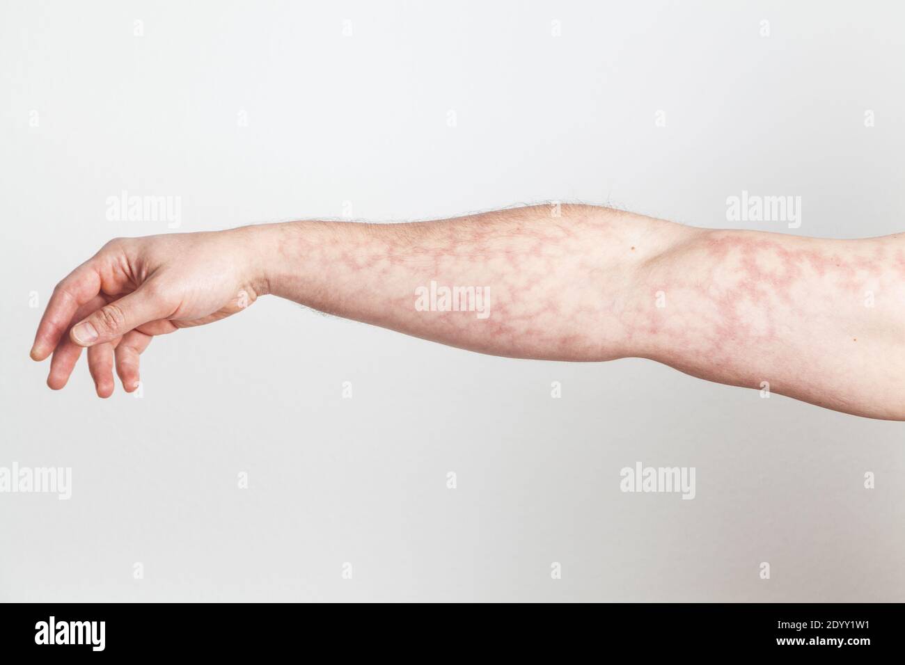 Male upright arm with red skin capillary network Stock Photo - Alamy