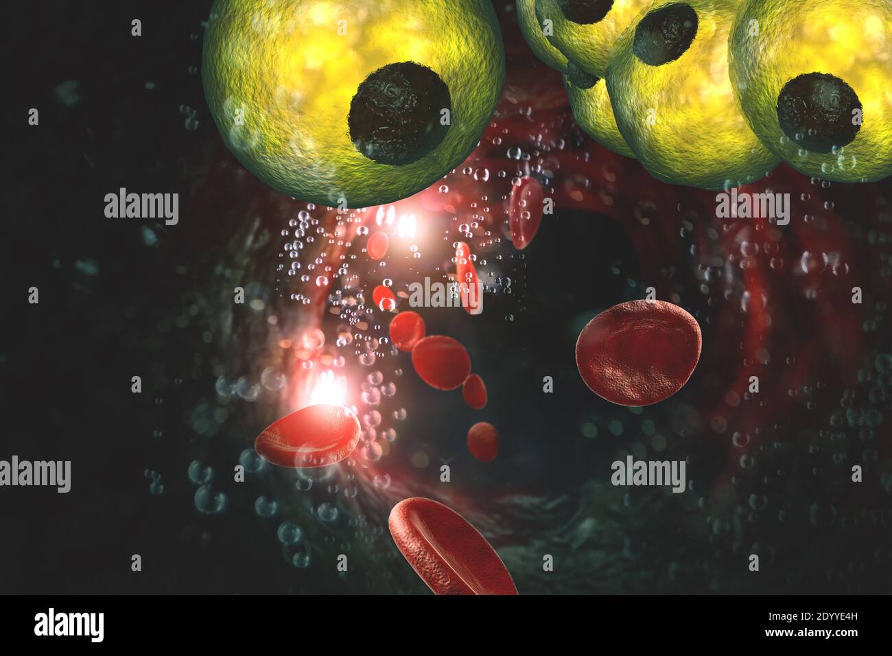 Artery clogged with fat cell plaque build up which will lead to heart ...