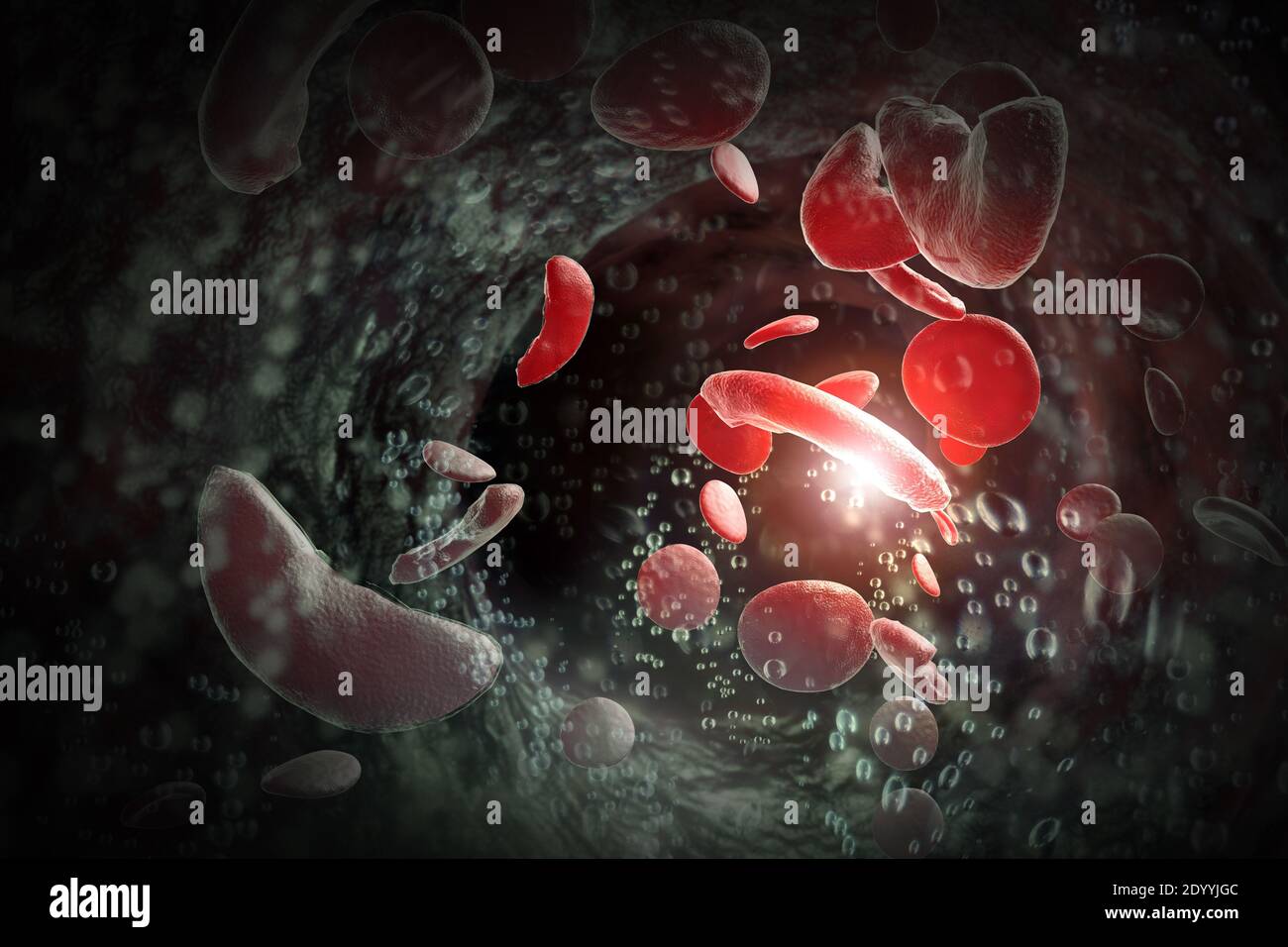 Sickle cell anemia blood cells hi-res stock photography and images - Alamy