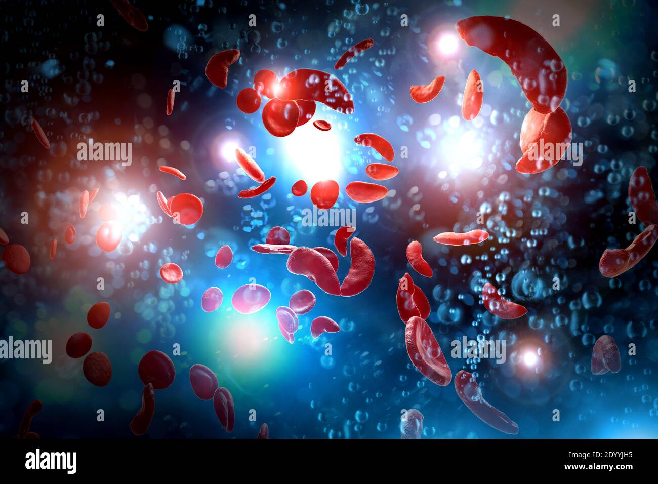 Sickle cell anemia disease (SCD) blood cells 3D illustration Stock ...