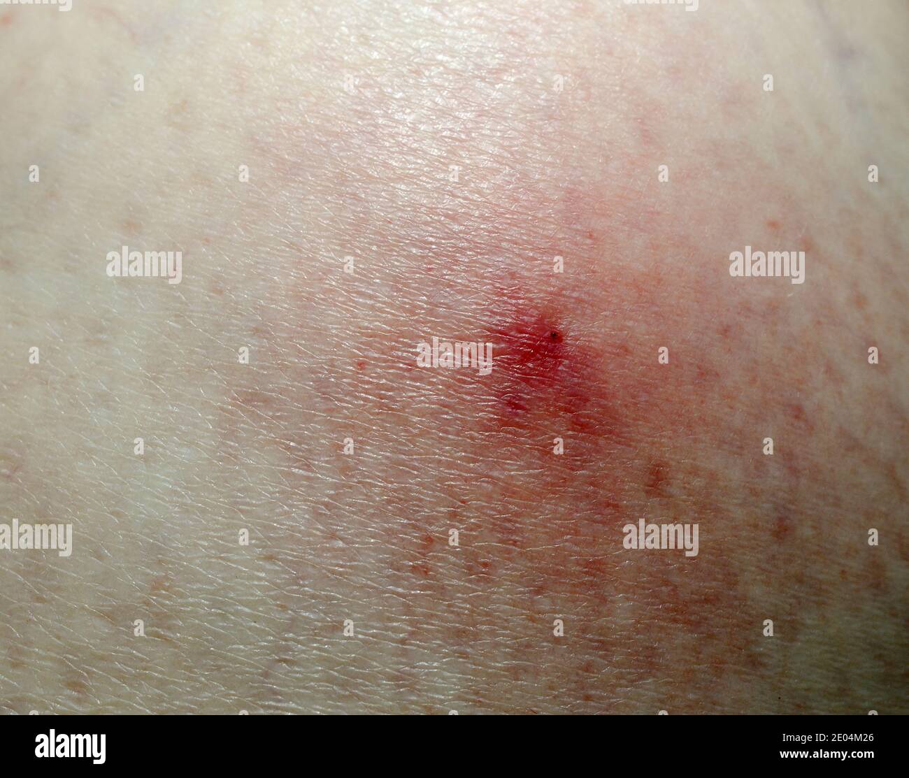 redness and tick bite marks on the skin Stock Photo - Alamy redness and tick bite marks on the skin Stock Photo - Alamy