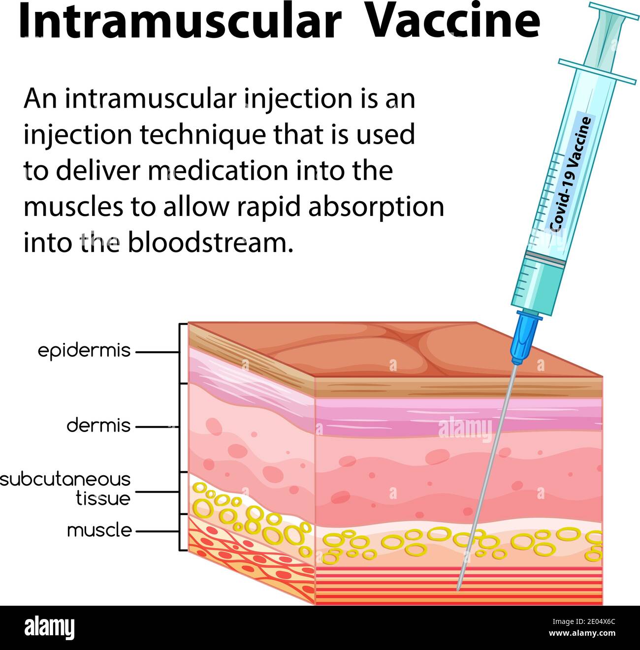 Information vector on intramuscular injection illustration Stock Vector ...
