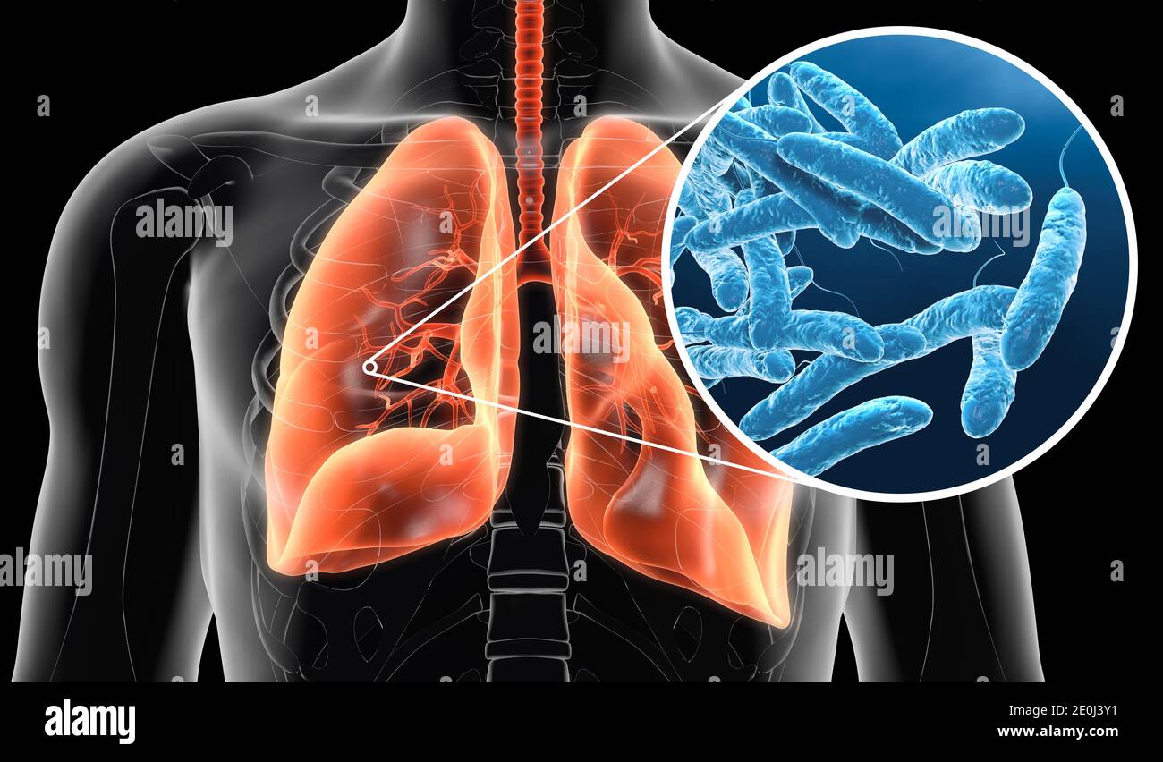 3D illustration showing legionella pneumophila bacteria in human lungs ...