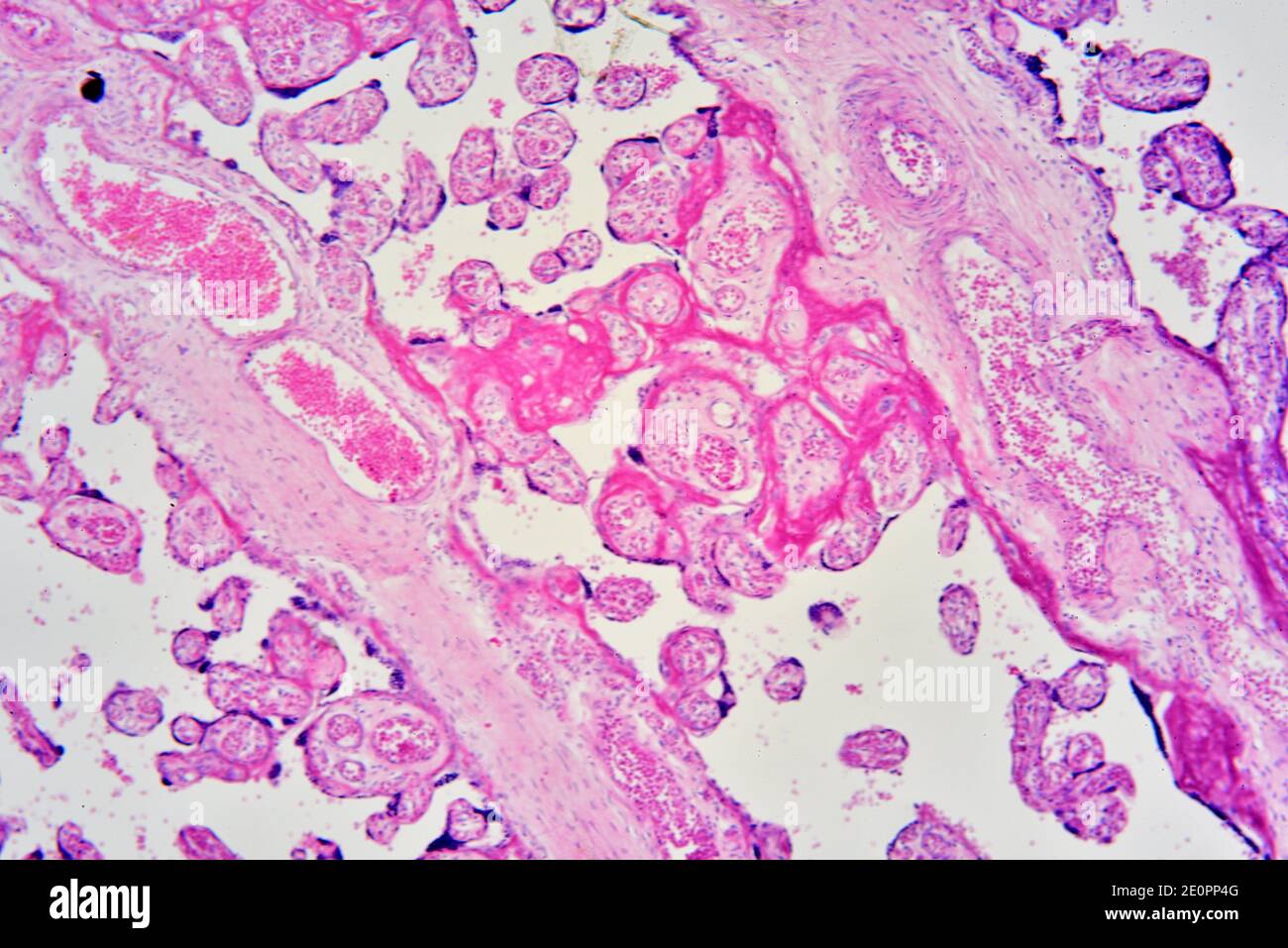 Chorionic Villi Histology