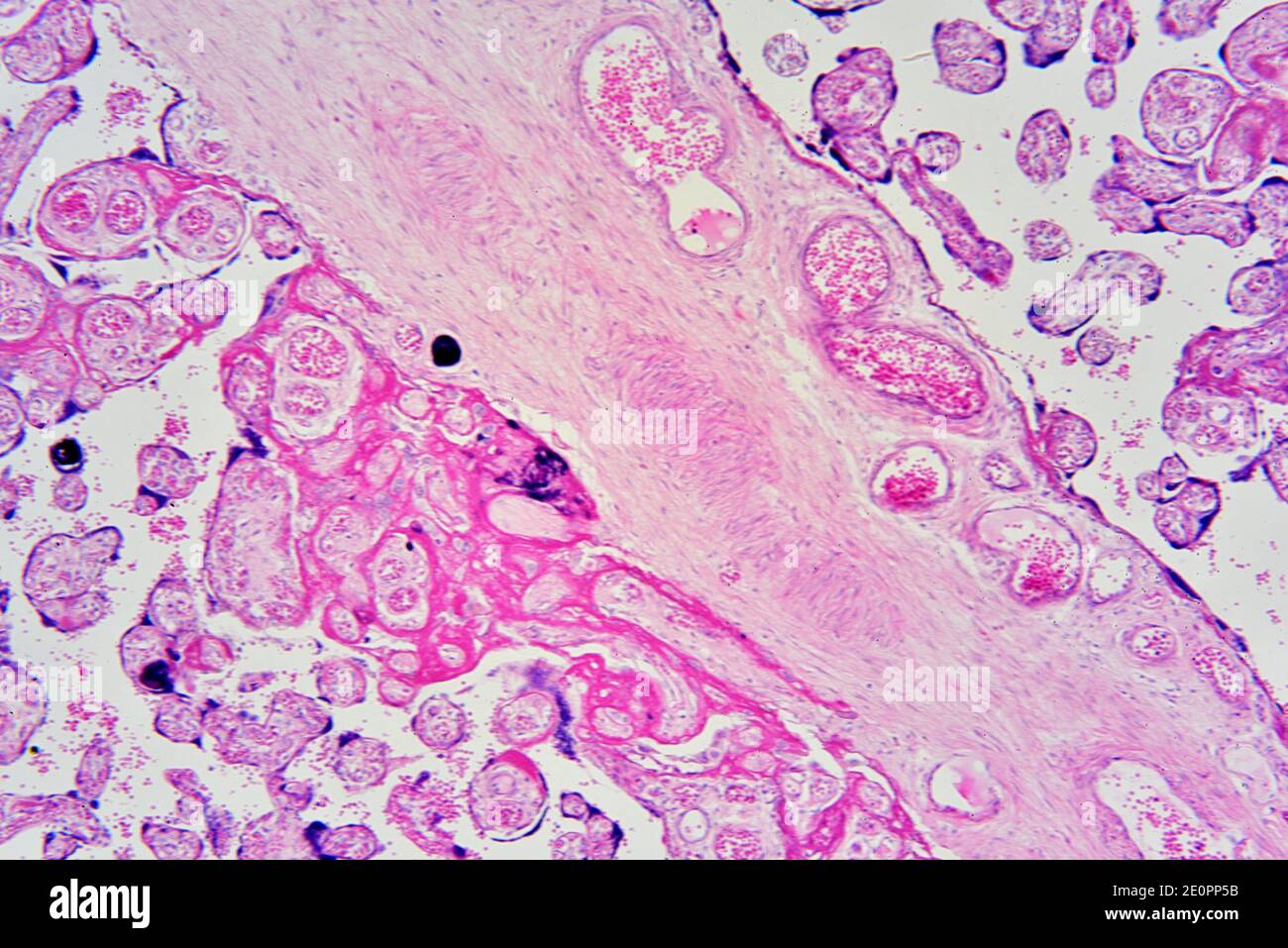 Chorionic Villi Histology